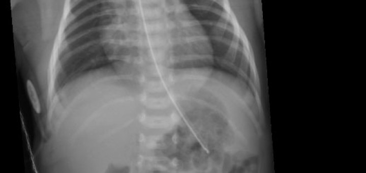 1 year old boy with abdominal distention and BNO for 3 days. – Asia ...